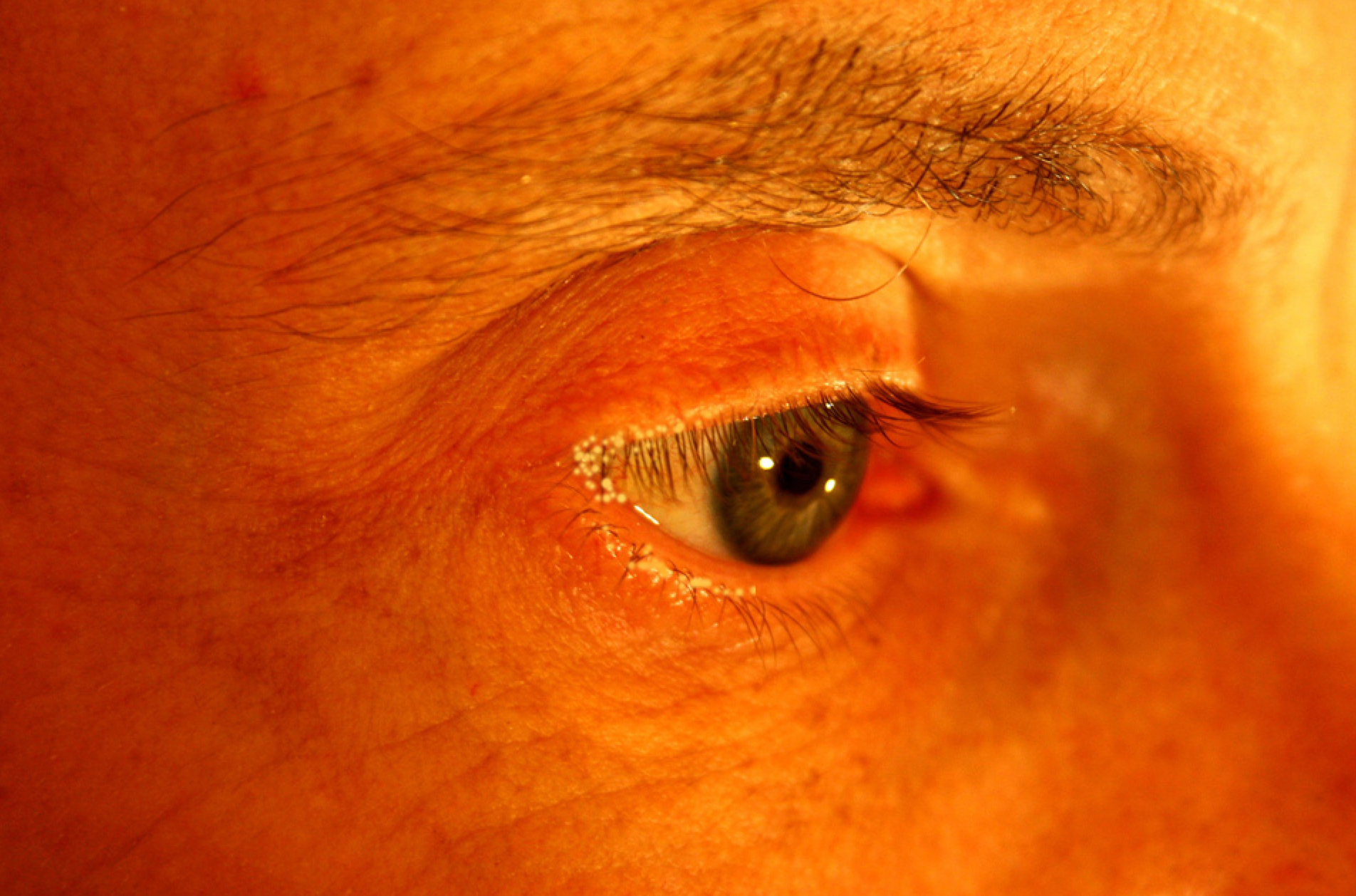 Question : Blépharite - Questions/réponses - Soignez-vous