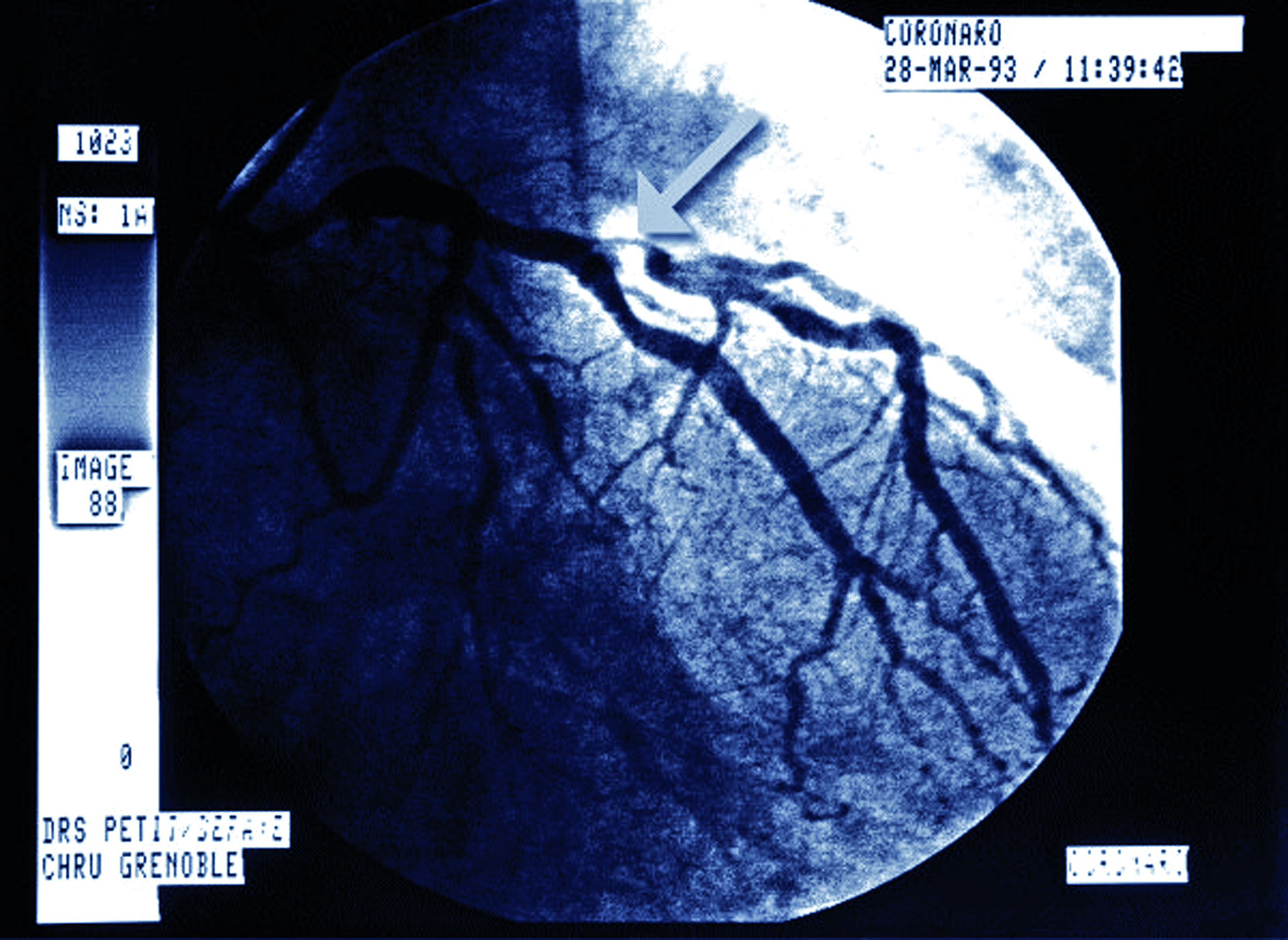 Comprendre les résultats de votre coronarographie - Soignez-vous